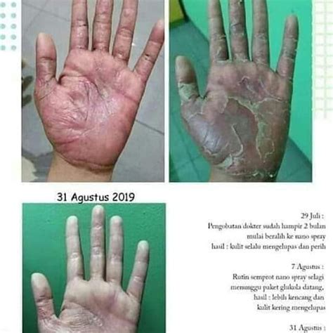 Mengenal Ciri Ciri Alergi Deterjen Dan Cara Mengatasinya 41 Off