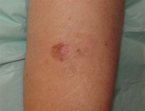 Signs Of Skin Cancer On Legs Pictures At Elizabeth Parmley Blog