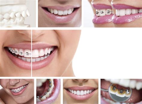 Top 10 Invisalign Questions And Answers Imperial Dental Associates