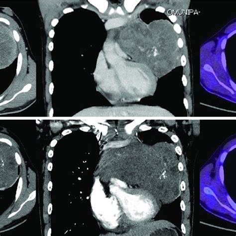 Our Experience With 14 Extragonadal Mediastinal Germ Cell Tumor