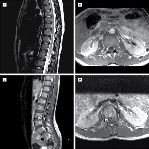 transverse myelitis plus syndrome and acute disseminated
