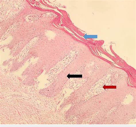 Skin Biopsy Showing Parakeratosis Of Stratum Corneum Blue Arrow