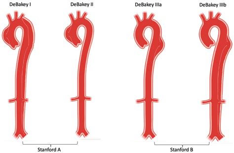 Aortic Dissection Encyclopedia Mdpi