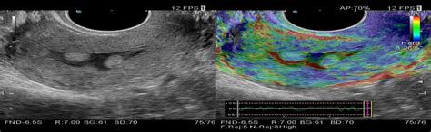 Figure 2 From Multiple Endometrial Polyps In A Pre Menopausal Woman