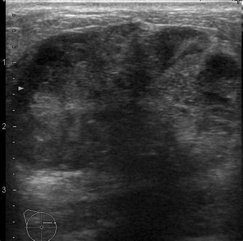 Ultrasonography Showed An Oval Circumscribed Heterogeneous Solid Mass