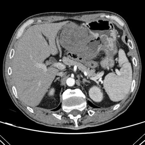 The Enhanced Contrast Ct Image Of A Gist With Hemorrhage The Typical
