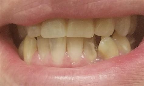 How To Know If You Have A Cavity In Your Front Teeth Ways To Tell If