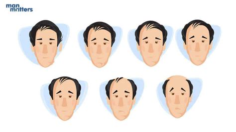7 Stages Of Male Pattern Baldness Male Balding Patterns 101