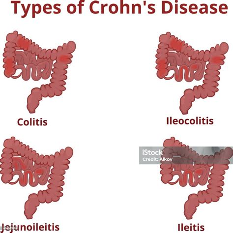 Crohns Disease Anatomy Classification Stock Illustration Download