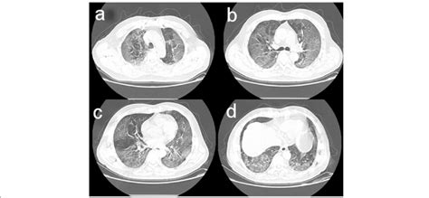 Chest Computed Tomographic Imaging Of The Lungs Performed On February