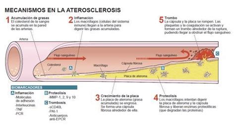 Arterioesclerosis Síntomas Tipos Diagnóstico Y Tratamiento Clínica