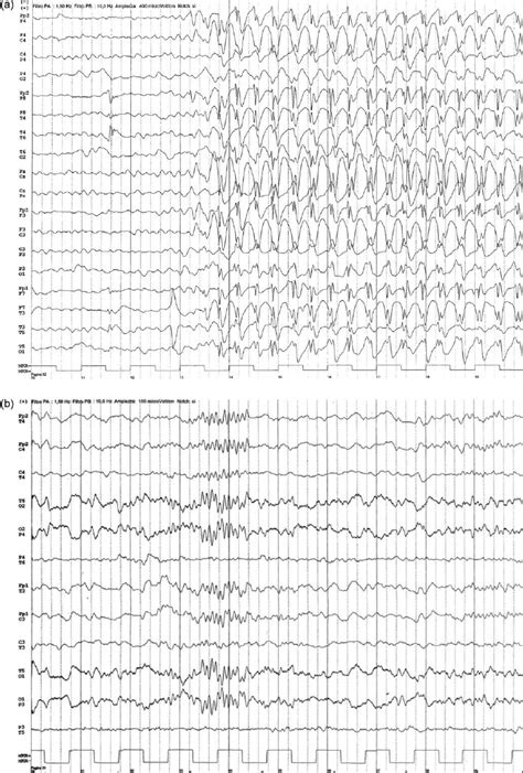 A The Ictal Eeg Showing Generalized Spike Wave Activity During A