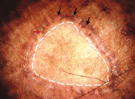Dermoscopic Image Of Annular Lesion Labelled In Fig 2 Displayed A
