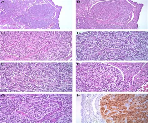 Microscopic Extraovarian Sex Cord Proliferations Report Of