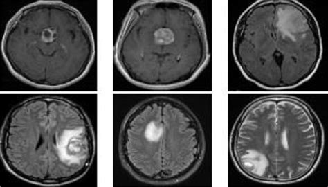 Scielo Brasil Mri Brain Tumor Classification Using A Hybrid Vgg16