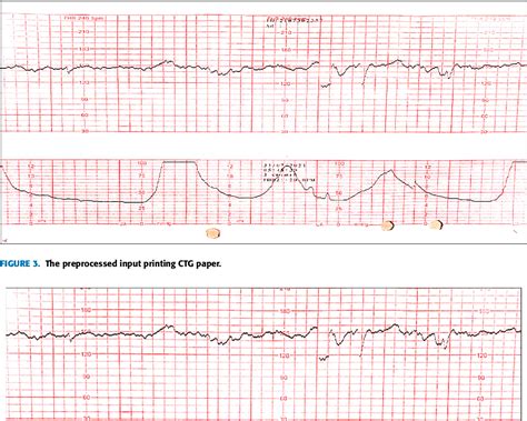 Figure 3 From A Novel Approach For Cardiotocography Paper Digitization