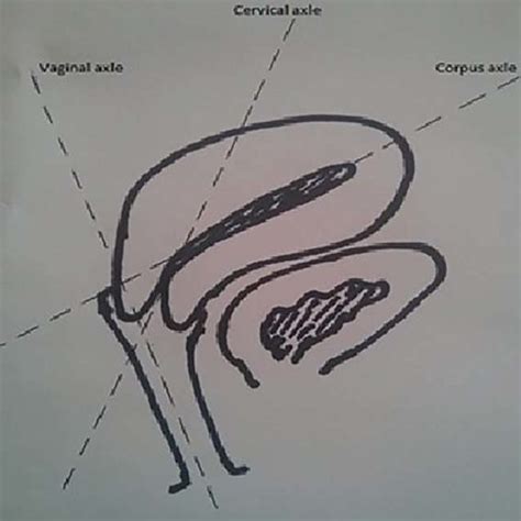 Different Uterine Anatomical Positions Except Rare Positions A