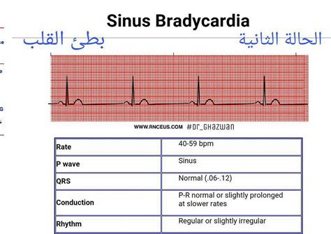 شرح تخطيط القلب الكهربائي Ecg وتحديد الحالة من رسم القلب أسرار دوت إنفو