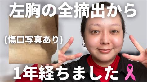 【注意🚨傷口写真あり】乳がんで左胸を全摘出してから1年が経ちました Youtube
