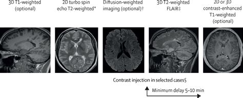 Mri Criteria For The Diagnosis Of Multiple Sclerosis