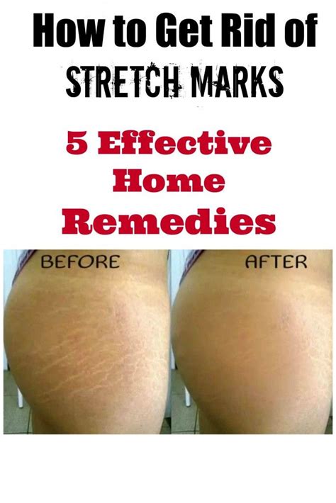 How To Get Rid Of Stretch Marks 5 Effective Home Remedies With Images