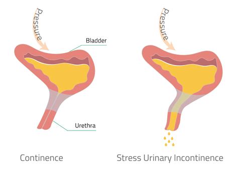 What Is Stress Urinary Incontinence Sui Yakima Urology Associates Pllc