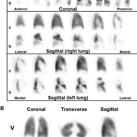summary of strengths and limitations of ctpa v q spect