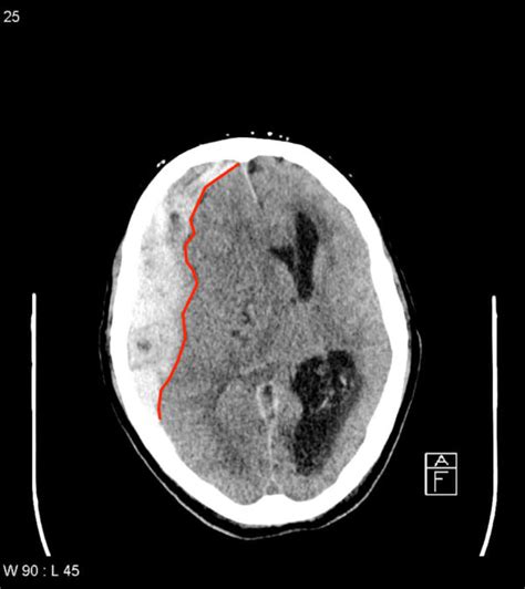 Subdural Haematoma Subdural Haemorrhage Geeky Medics