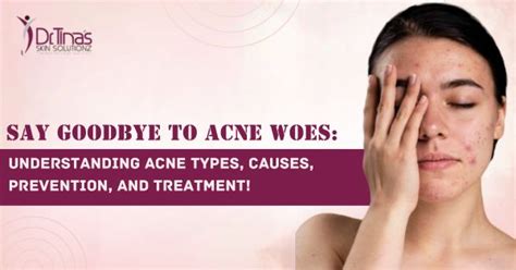 Acne 101 A Comprehensive Guide To Understanding Acne Types Causes