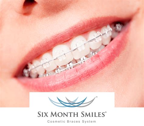 Braces Derby Invisalign Invisible Clear Braces Damon Incognito