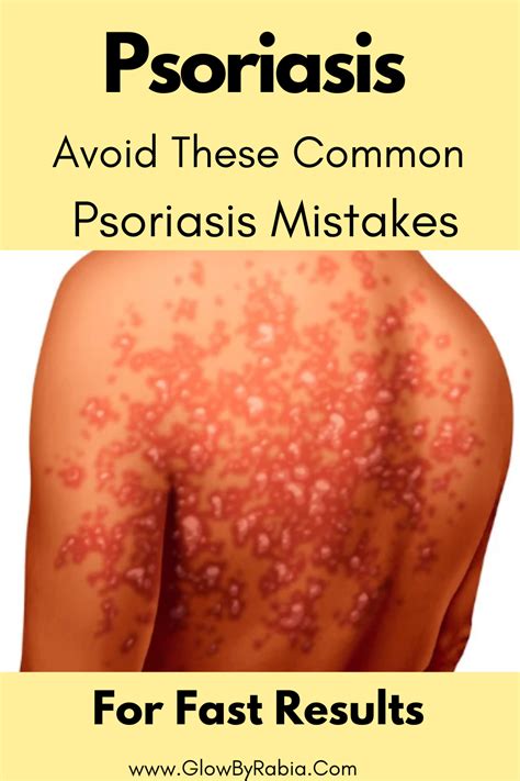 What Is Psoriasis Symptoms Causes Diagnosis Treatment And Prevention
