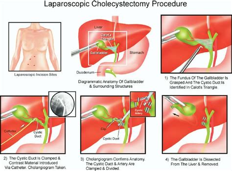 figure 2 a laparoscopic cholecystectomy with intraoperative