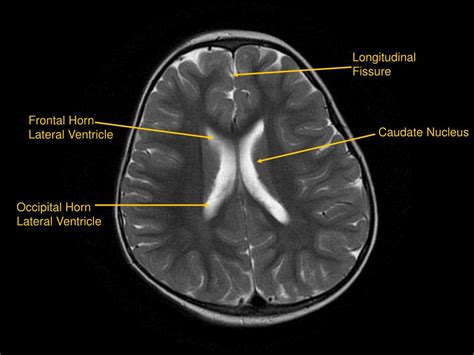 Ppt Mri Of Brain Head And Neck Powerpoint Presentation Free Download