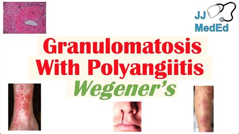 Granulomatosis With Polyangiitis Wegeners Granulomatosis Symptoms