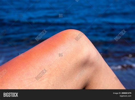 Woman Leg Red Sunburn Image And Photo Free Trial Bigstock