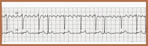 float nurse practice ekg strips 383