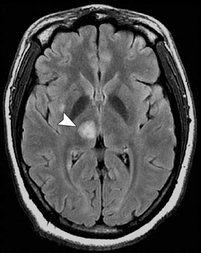 Diagnostic Approach To Intrinsic Abnormality Of Spinal Cord Signal