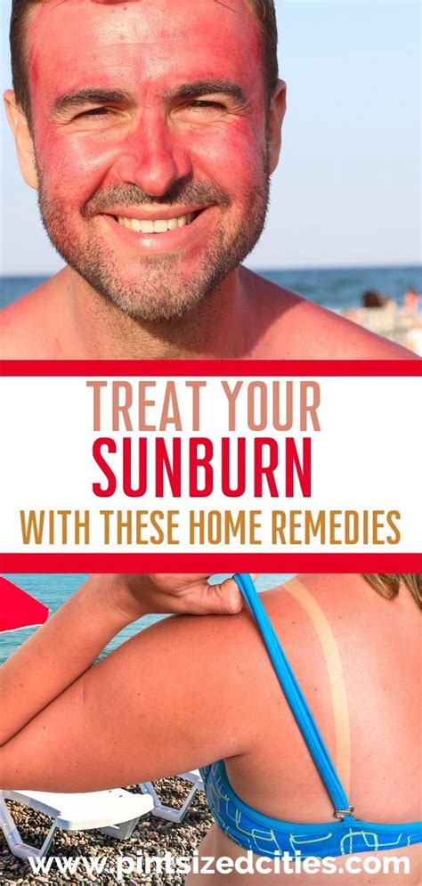 Sunburn Home Remedies Home Remedies For Sunburn Sunburn Treatment