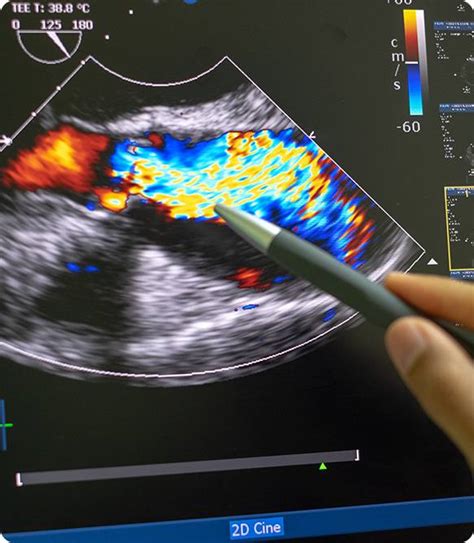 Contrast Echocardiography – Cardiac Care North York