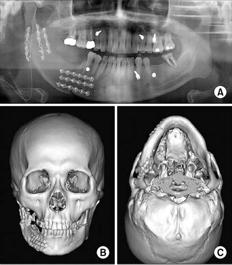 Postoperative 3 Dimensional Computed Tomography Reconstructed Images