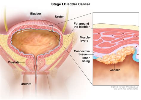 [table] Table 2 Definition Of Tnm Stage Ia Pdq Cancer Information