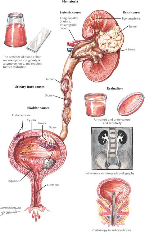 Bartholins Gland Abscess Infection Clinical Gate