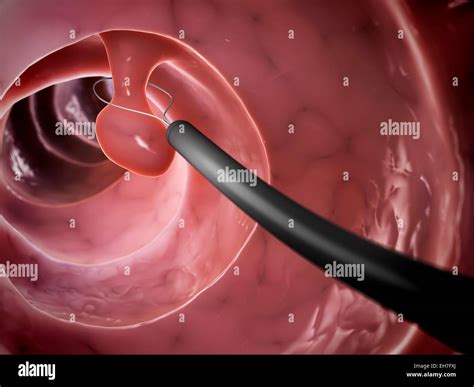 Colonoscopy Polyp Removal