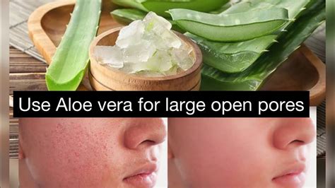 How To Get Rid Of Large Open Pores Open Pores Treatment 100