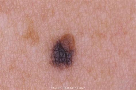 Combined Nevus South East Skin Clinic