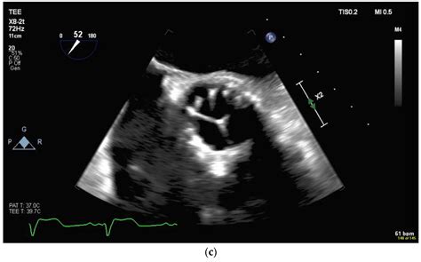Diagnostics Free Full Text Advances In Tee Centric Intraprocedural