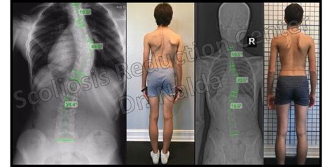 Scoliosis Treatment Results See Before And After Pictures