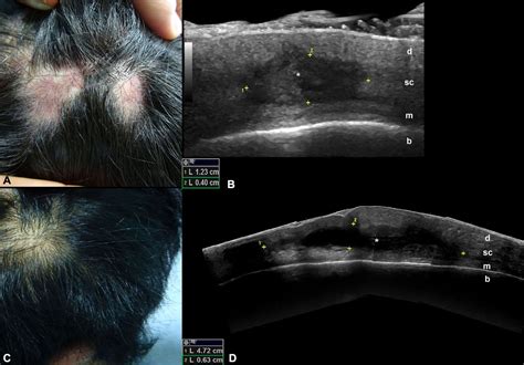 Imaging Techniques In Hidradenitis Suppurativa And Comorbidities
