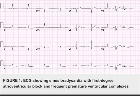Figure 1 From Isolated Cardiac Sarcoidosis Presenting As Torsades De