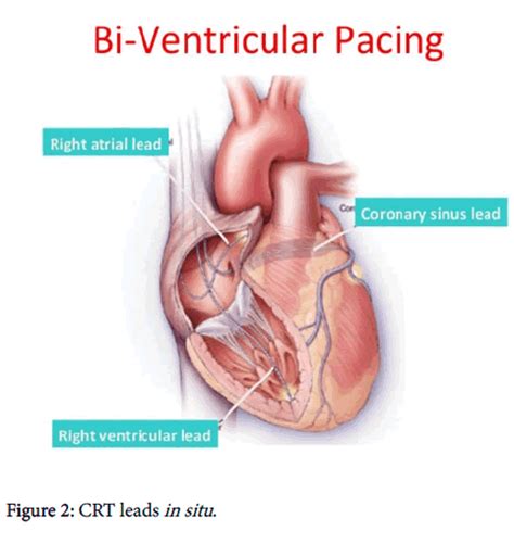 Lv Lead Position In Crt